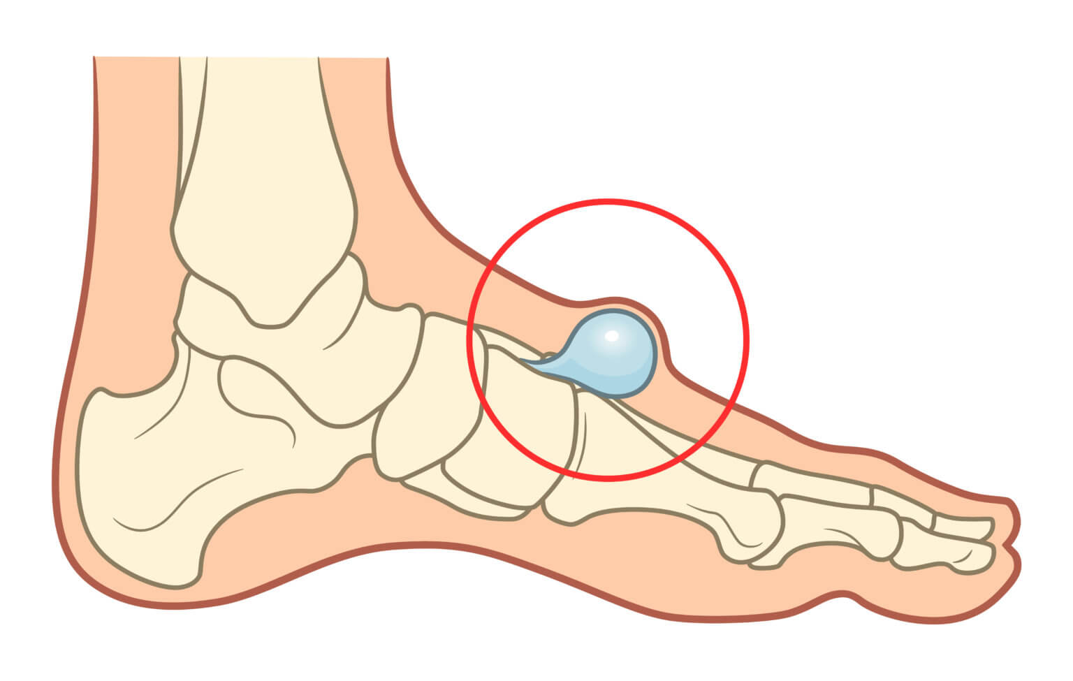 Ganglion So Verschwindet Es Lebensfreude Aktuell Ganglion So Verschwindet Es Lebensfreude Aktuell